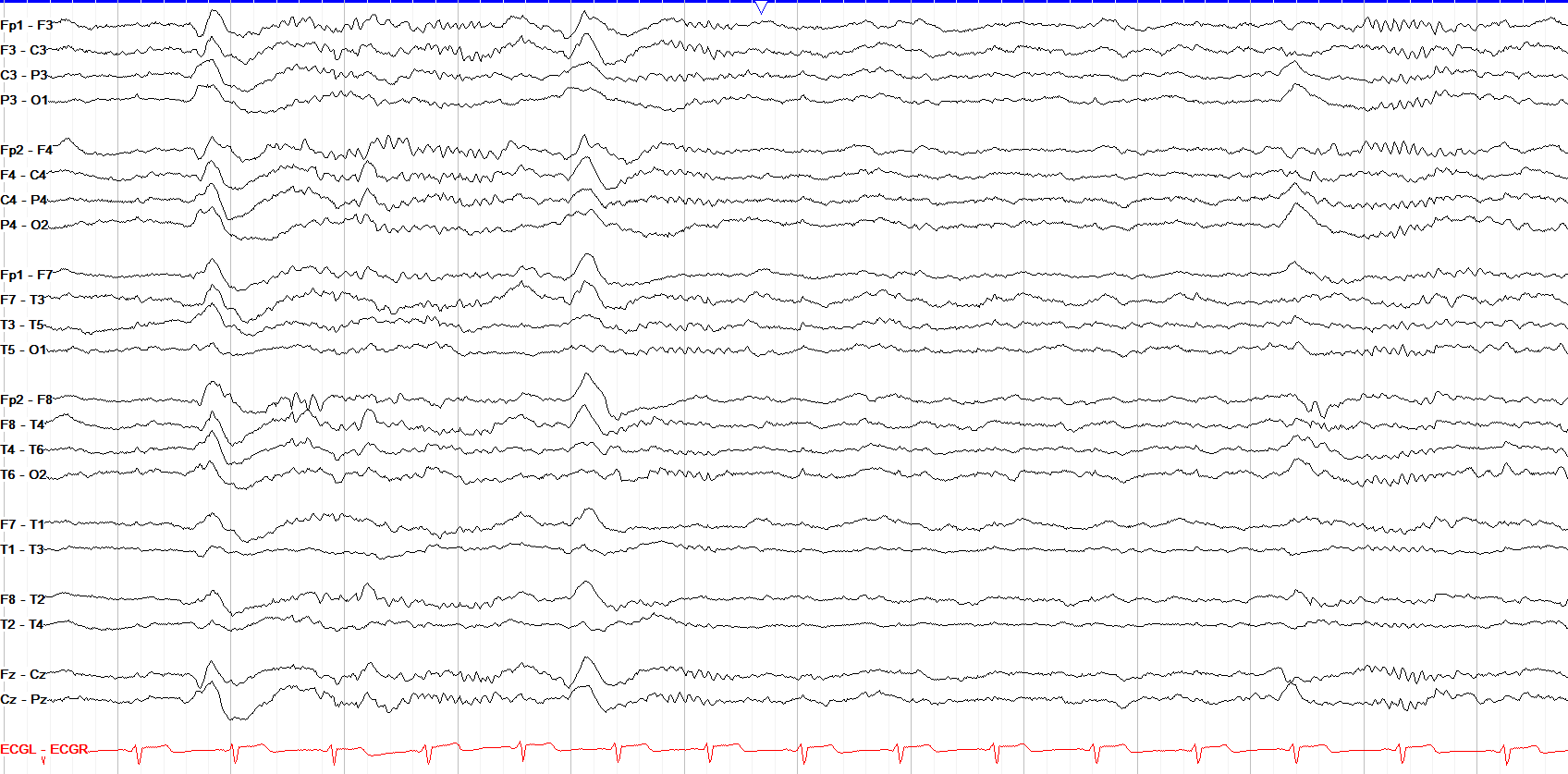 The Normal Asleep EEG